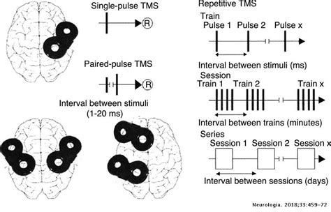 Current Evidence On Transcranial Magnetic Stimulation And Its Potential Usefulness In Post