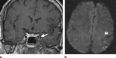 Fungal Vasculitis Confirmed At Biopsy Of The Sphenoid Sinus Mucosa In Download Scientific