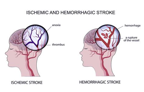 Understanding Ischemic Stroke Causes Symptoms And Prevention Barry