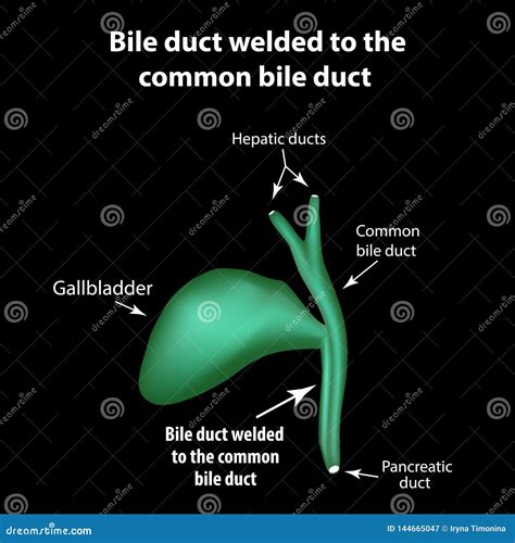 Pathology Of The Gallbladder The Bend Of The Gallbladder Set Vector