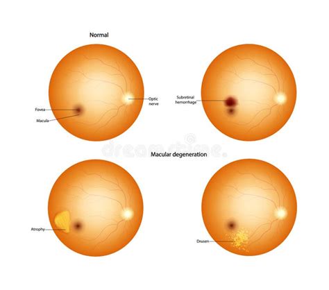 Drusen Stock Illustrations 23 Drusen Stock Illustrations Vectors