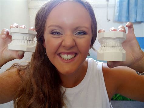 She S A Gentry My Braces Experience Having My Braces Off