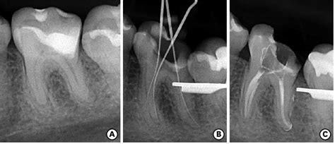 Root Canal Treatment A Preoperative Radiograph B Determination Of