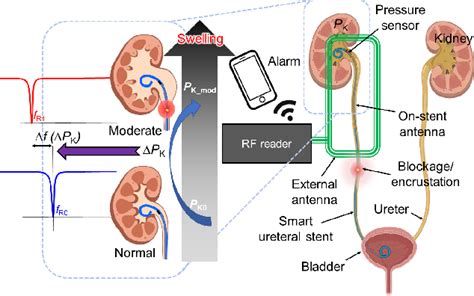 Figure 1 From A Sensor Integrated Smart Ureteral Stent And Wireless In Vitro Test For Real