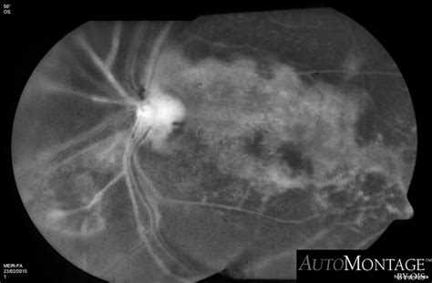 PORN Retina Image Bank