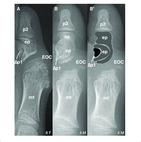 Longitudinal Epiphyseal Bracket In Subjects With Fop A Radiograph Download Scientific