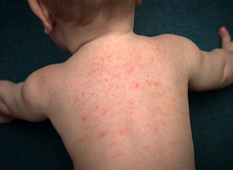 Teething Rash On Body Renew Physical Therapy