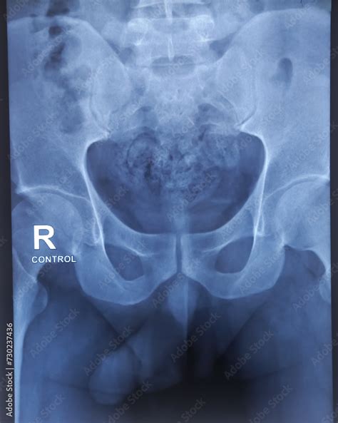 X Ray Film Of Rgu And Mcu Retrograde Urethrogram And Micturating Cystogram Radiological Test