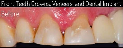 Diagonal Dental Of Boulder Before And After Photos Boulder Dentist