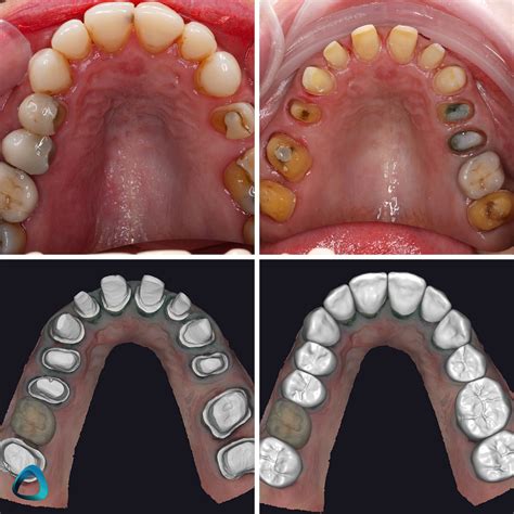 A Digital Approach To A Full Mouth Rehabilitation Institute Of