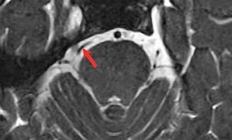 Microvascular Decompression For Trigeminal Neuralgia The Neurosurgical Atlas By Aaron Cohen