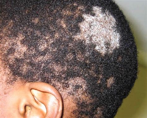 Ringworm Tinea Causes Signs Symptoms Diagnosis Treatment