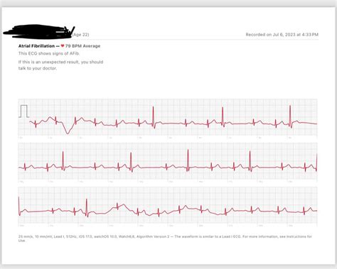 Atrial Fibrillation R Readmyecg