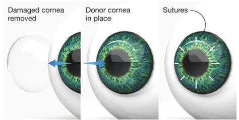 Keratoconus Eye Doctors