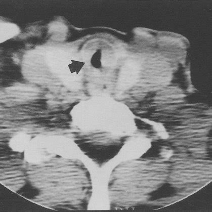 Computed Tomographic Scan Of The Subglottic Larynx Showing Stenosis Of