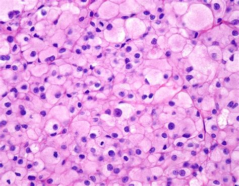 Balloon Cell Melanoma Light Micrograph Stock Image C051 1620 Science Photo Library