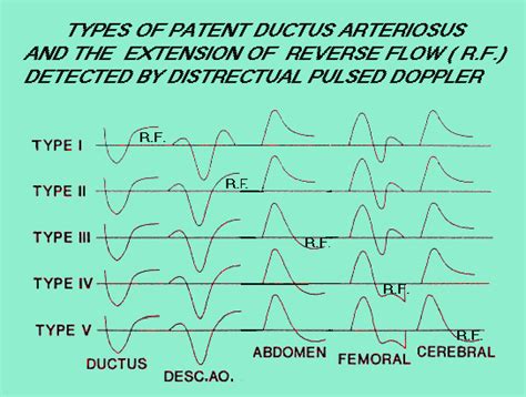 Pda In Newborn Infants Percar Perinatal Cardiology