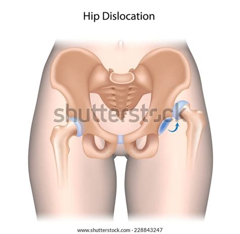Hip Dislocation Stock Illustration 228843247