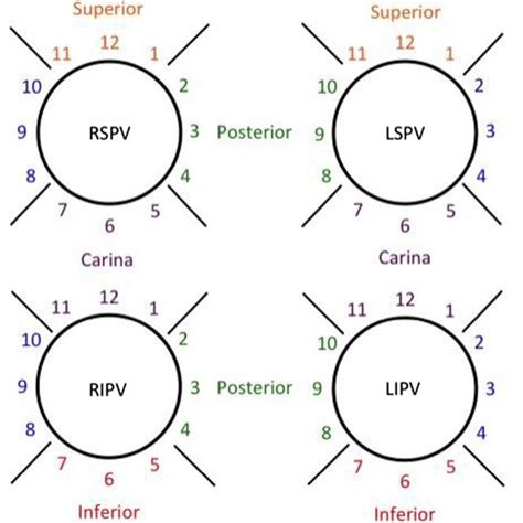 Simultaneous Pace Ablate During Carto Guided Pulmonary Vein Isolation