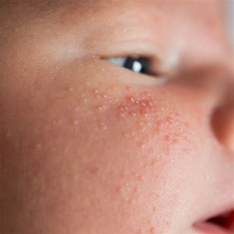 Sarpullido Por Calor En Bebés Tratamientos Y Prevención Minenito