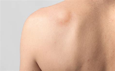 Lipoma Removal From £425 Leeds Bradford Harrogate Skin Surgery Clinic