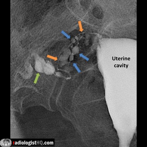 Salpingitis Isthmica Nodosa On Hysterosalpingogram Rradiology