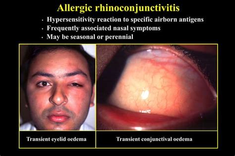 Allergic Conjunctivitis Ppt