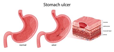 Premium Vector Normal Stomach And Peptic Ulcer Illustration