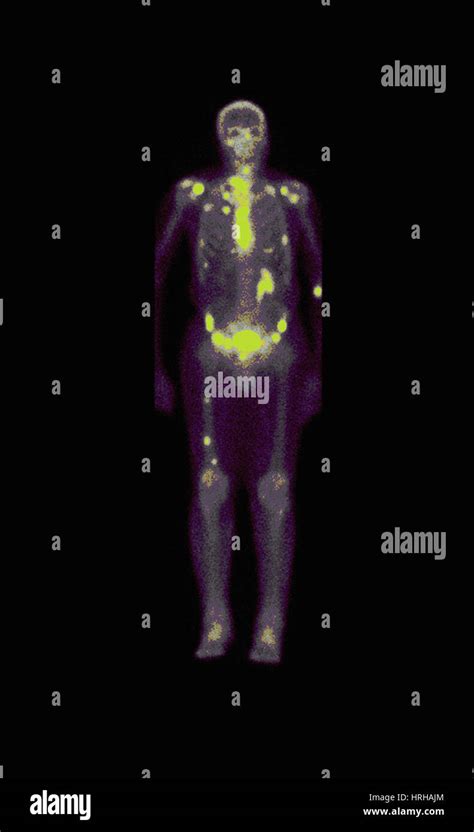 Abnormal Bone Scan Hi Res Stock Photography And Images Alamy
