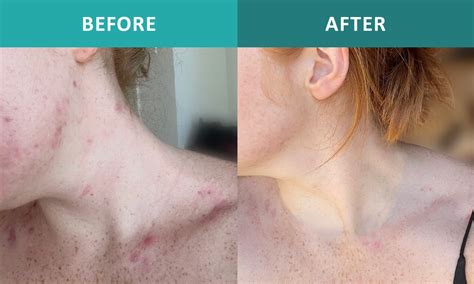 Dermatologist With Acne Patient