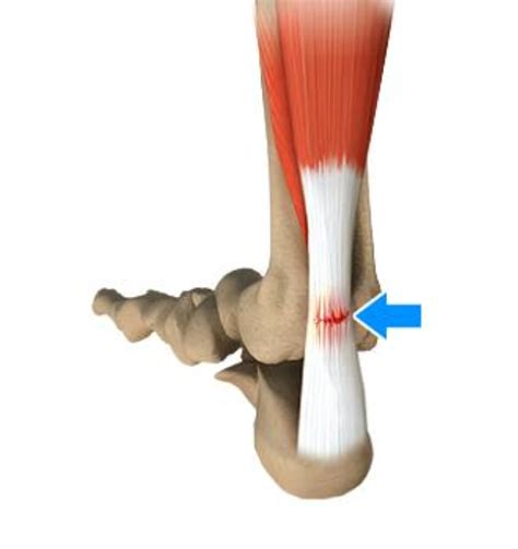 Achilles Tendon Rupture Bunbury Foot And Ankle Surgeon