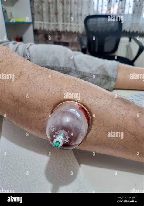 Leech Therapy On The Legs Is A Method Used In Traditional Medicine