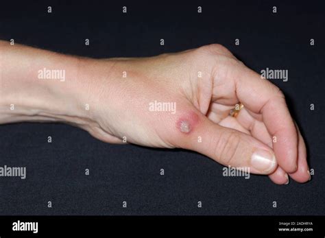 Insect Bite On The Thumb Of A 44 Year Old Woman The Bite Has Become Infected And Inflamed Stock