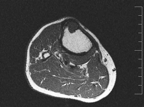 A 58 Year Old Man With A Right Proximal Tibia Lesion