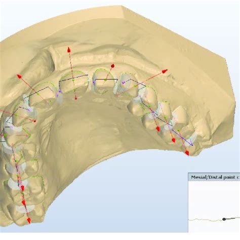 Of Arch Length Tooth Material Discrepancy Between Plaster And Digital