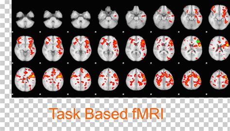 Functional Magnetic Resonance Imaging Brain Default Mode Network Functional Neuroimaging Png