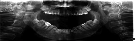 Inferior Repositioning Of Coronoid Process For The Treatment