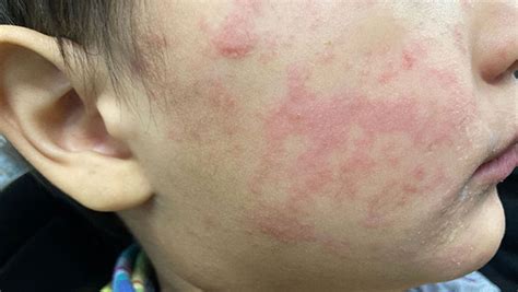 Maculopapular Rash