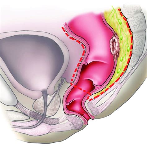 Extent Of Total Mesorectal Excision Download Scientific Diagram