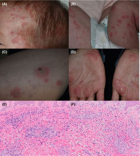 A B Skin Rash With Annular Erythematosus Lesions On The Face Trunk Download Scientific