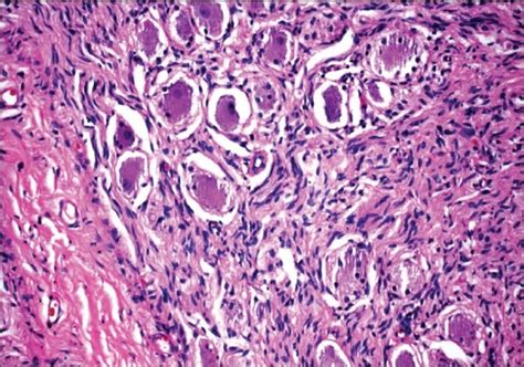 Ganglion Cell Tumor