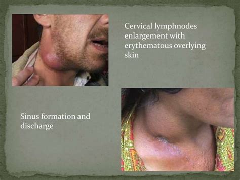 Tuberculosis Oral Pathology