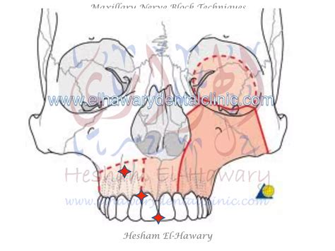 Maxillary Nerve Block Anesthetic Technique With Photos Pdf Ear Nose And Throat Conditions