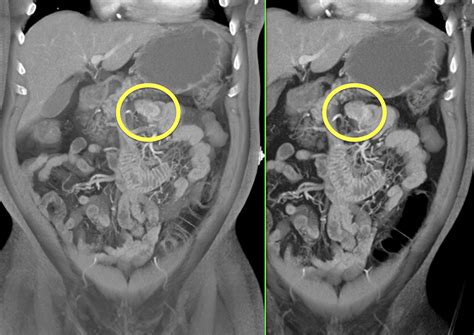 Gastrointestinal Learning Modules Ct Scanning