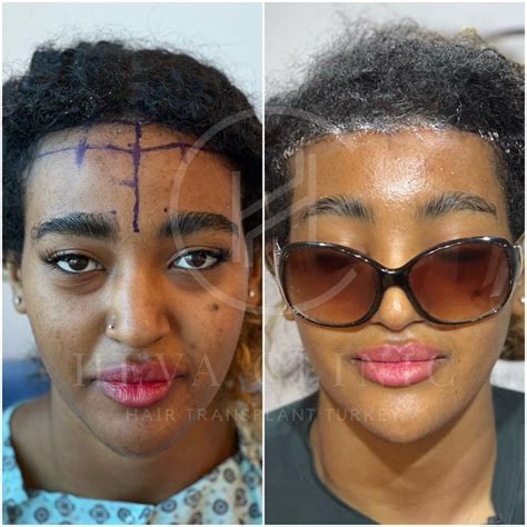 Forehead Reduction Hairline Lowering In Turkey Forehead Reduction