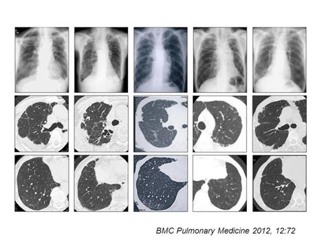 Mild Cylindrical Bronchiectasis Comprehensive Guide To Treatment Symptoms And Prognosis