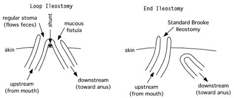 Gut Less Ileostomy