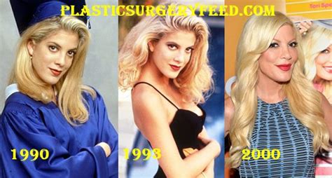 Tori Spelling Before And After Plastic Surgery Plastic Surgery Feed