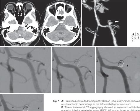 Figure 1 From Usefulness Of Stent Assisted Coil Embolization For Treatment Of Posterior Inferior