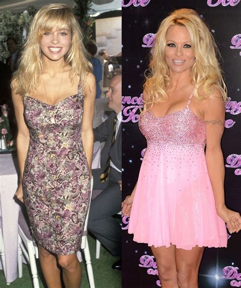 Pamela Anderson Before And After Plastic Surgery Hwhpcj